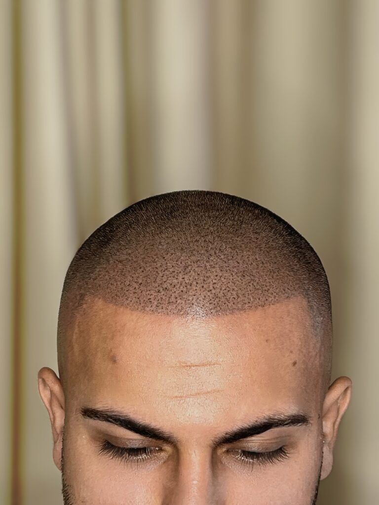 SMP (Scalp Micropigmentation) - Dots & Lines PMU & TATOO STUDIO