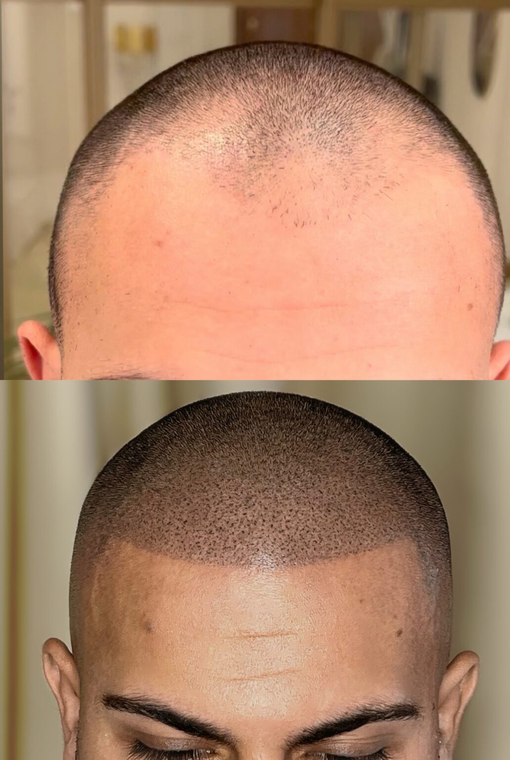 SMP (Scalp Micropigmentation) - Dots & Lines PMU & TATOO STUDIO